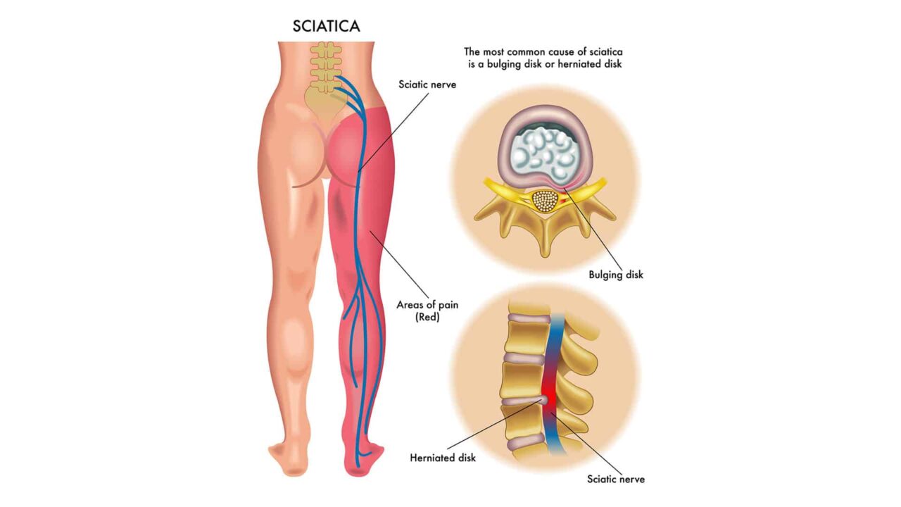 How to treat Sciatica Pain? - Tramedhealth - Traditional medicine & health